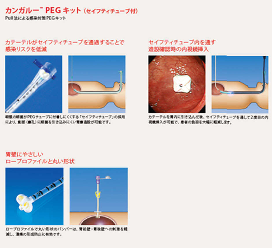 カンガルー PEGキット【セイフティチューブ付】｜日本コヴィディエン(株)｜Ch1.PEG｜PDNレクチャー