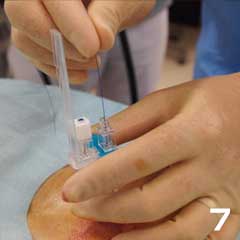 Chapter1 PEG 3.造設 1造設手技④Introducer変法｜PDNレクチャー