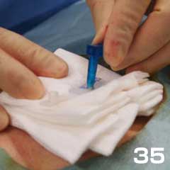 Chapter1 PEG 3.造設 1造設手技④Introducer変法｜PDNレクチャー